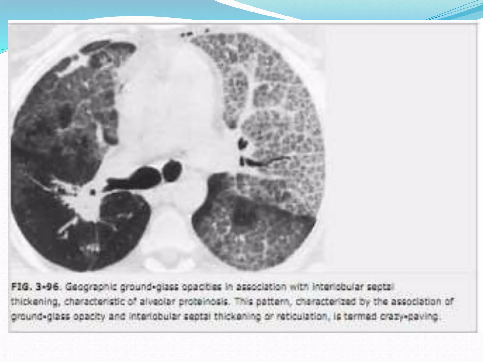 Interstitial lung-diseases | PPT