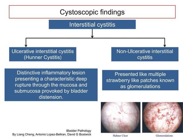 Interstitial cystitis | PPTX