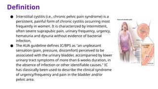 Interstitial Cystitis - PPT.pptx AND ITS TREATMENT | PPT