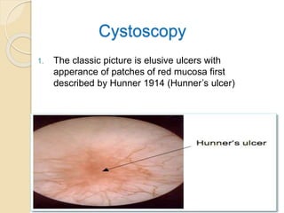 Interstitial cystitis[1] | PPTX | Sexual Conditions | Sexual Health