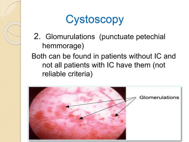 Interstitial cystitis[1] | PPTX | Sexual Conditions | Sexual Health