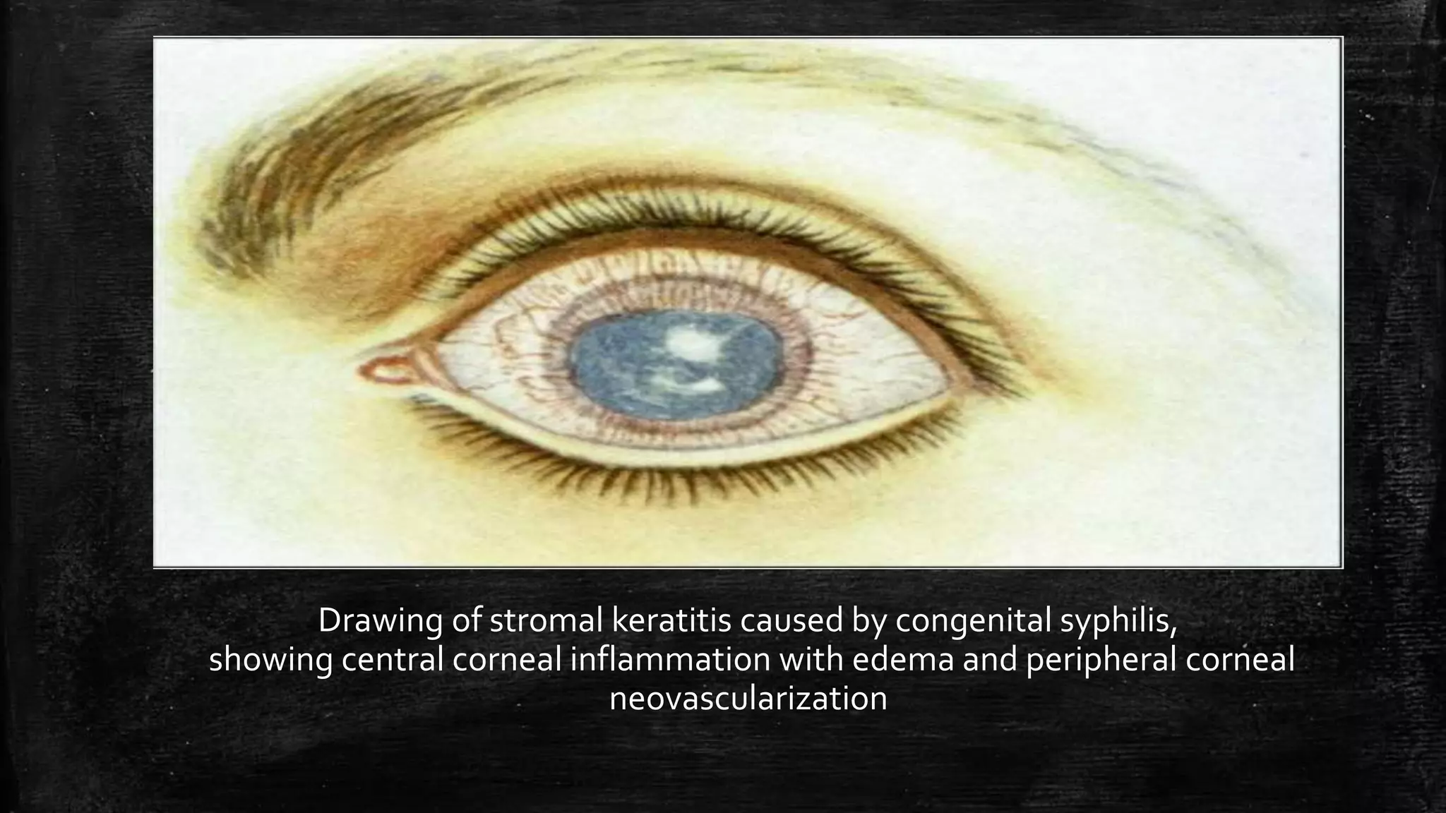 Interstitial keratitis | PPTX