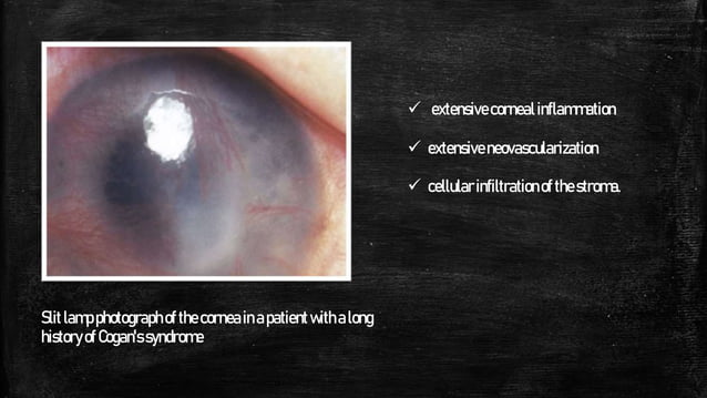 Interstitial keratitis PowerPoint presentation | PPTX