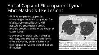 Interstitial Lung Abnormalities in CT.pptx