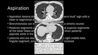Interstitial Lung Abnormalities in CT.pptx