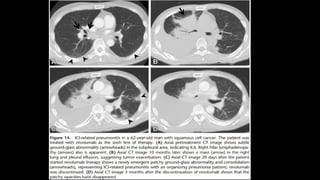 Interstitial Lung Abnormalities in CT.pptx
