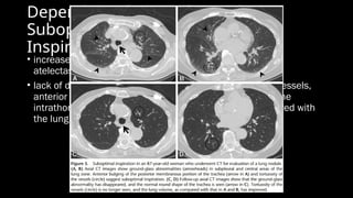 Interstitial Lung Abnormalities in CT.pptx