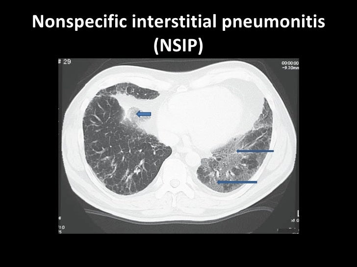 Interstitial Lung Disease