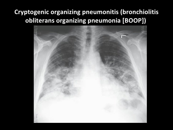 Interstitial Lung Disease