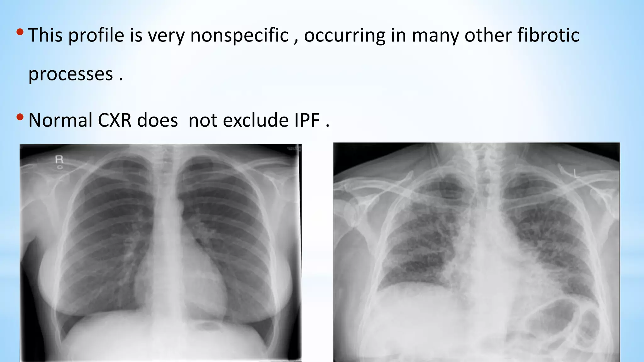 Practical approach to Idiopathic Pulmonary Fibrosis. | PPTX