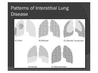 Interstitial lung disease | PPT