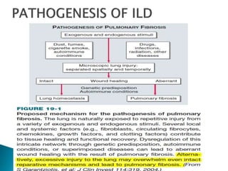 Interstitial lung disease; Basic Understanding and approach | PPTX ...