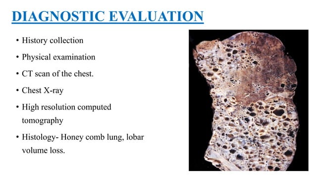 Interstitial lung disease | PPTX