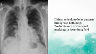 Interstitial lung disease.HR