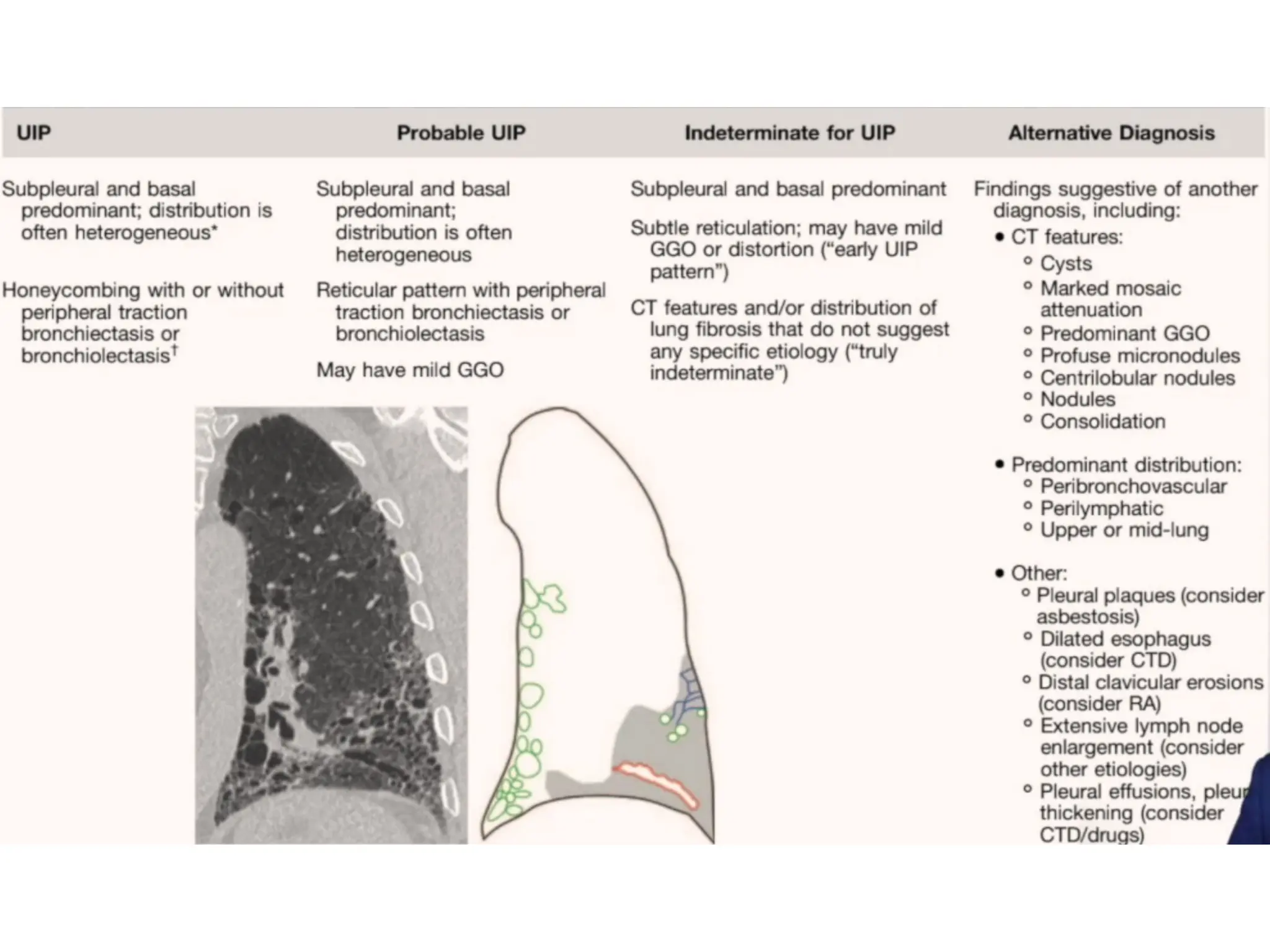 INTERSTITIAL LUNG DISEASE HRCT APPROACH.pptx