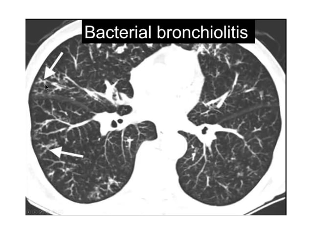 INTERSTITIAL LUNG DISEASE HRCT APPROACH.pptx