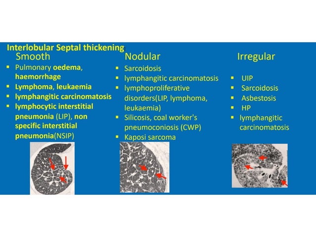 INTERSTITIAL LUNG DISEASE HRCT APPROACH.pptx