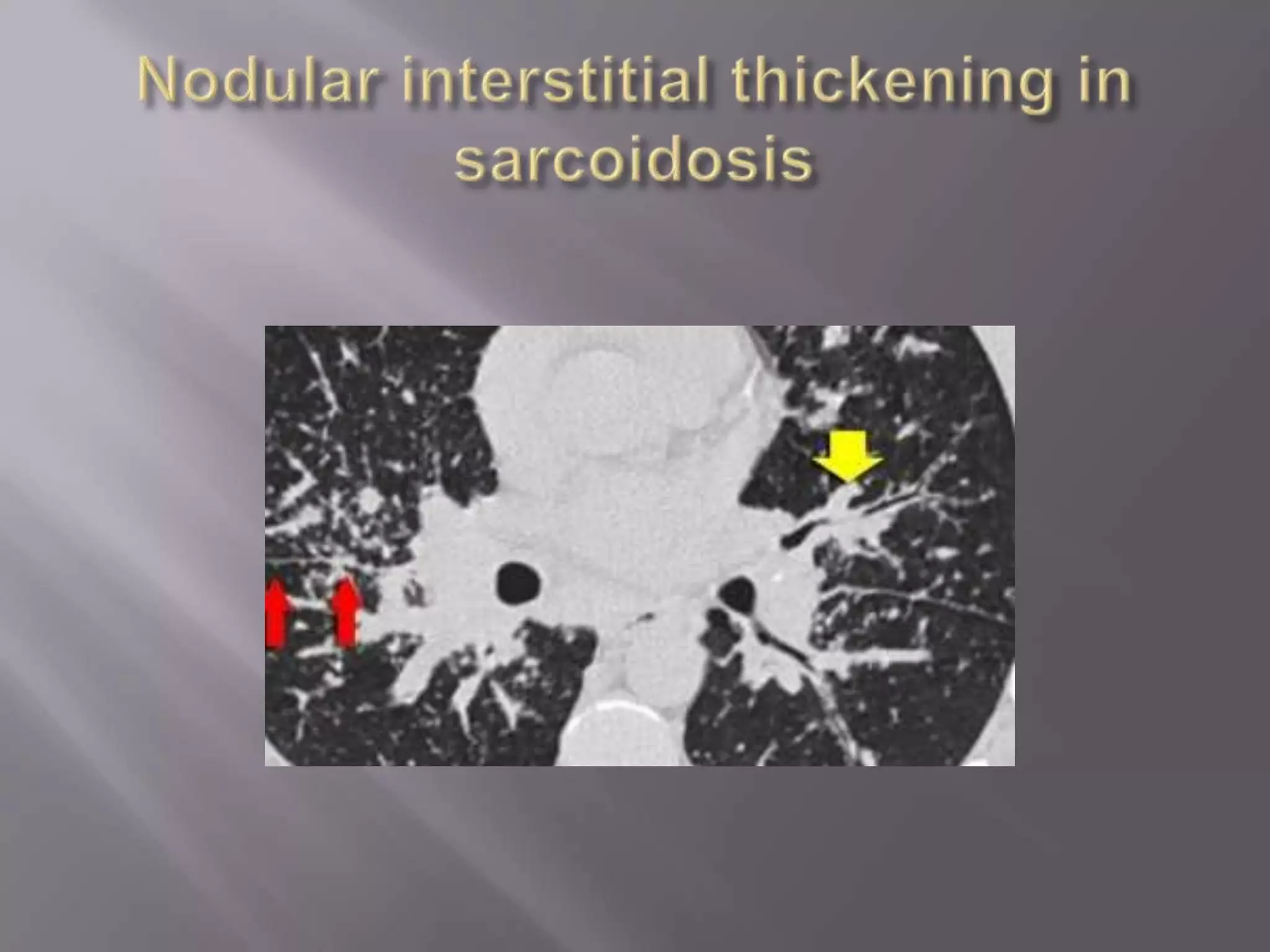Interstitial lung diseases- HRCT | PPTX