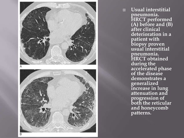Interstitial lung diseases- HRCT | PPTX