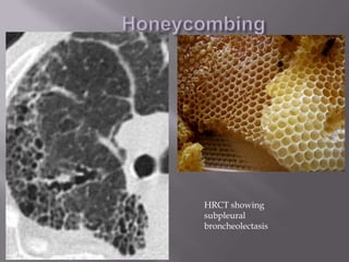 Interstitial Lung Disease Honeycombing