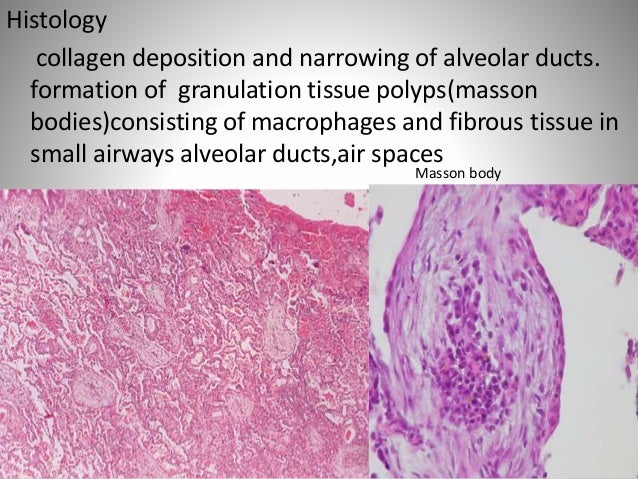 PFT and Interstitial lung diseases