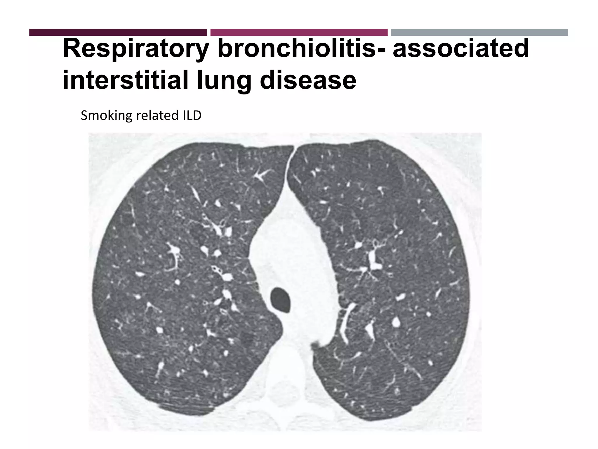 Interstitial Lung Diseases [ILD] Approach to Management | PPTX