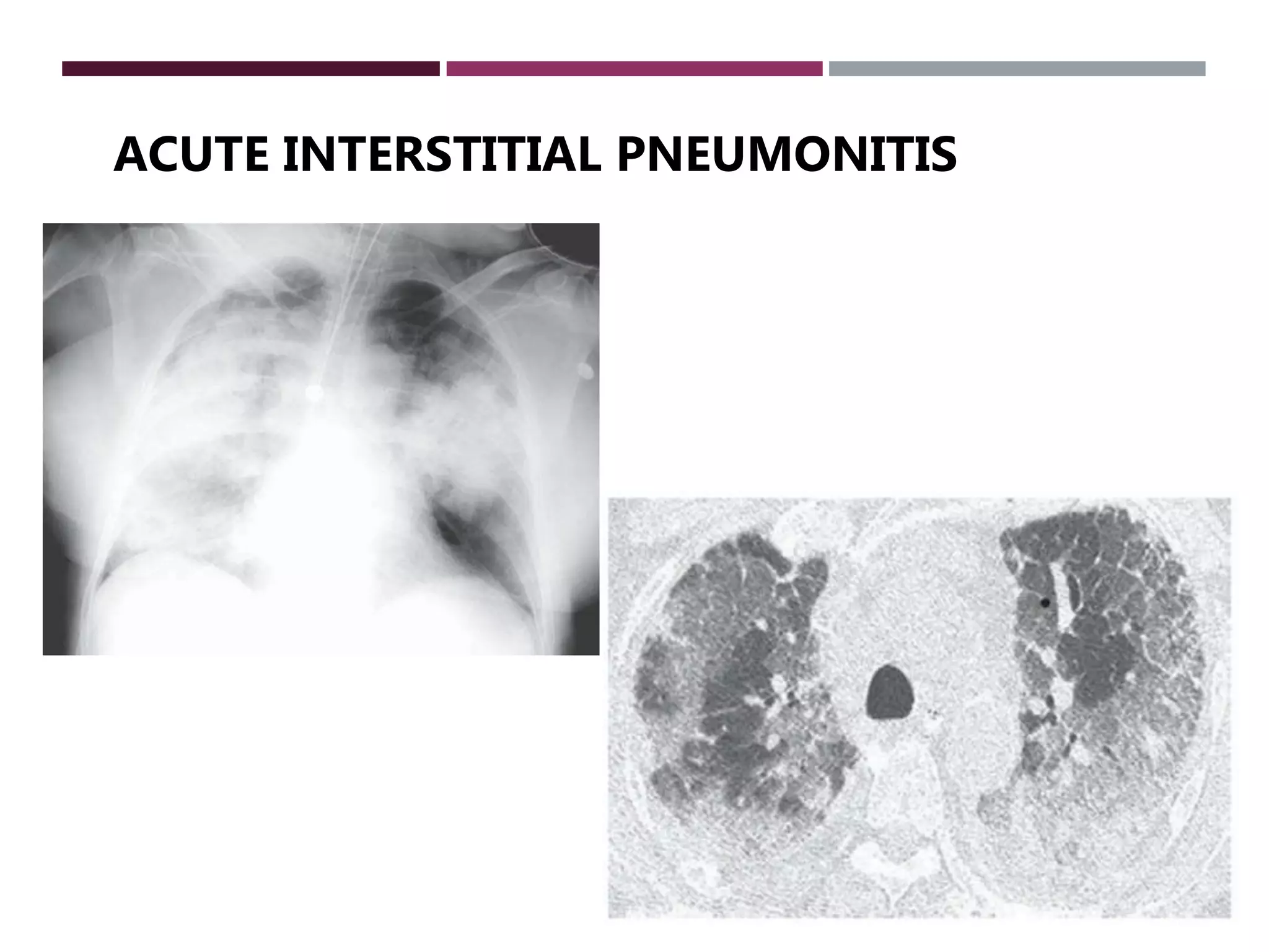 Interstitial Lung Diseases [ILD] Approach to Management | PPTX