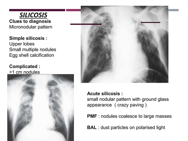 Interstitial Lung Diseases [ILD] Approach to Management | PPT