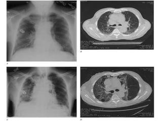Interstitial Lung Diseases [ILD] Approach to Management | PPTX