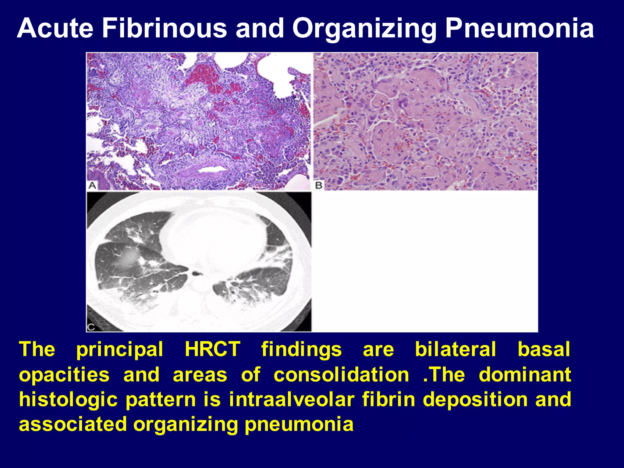 Diffuse parenchymal lung diseases (Postgraduate course) | PDF