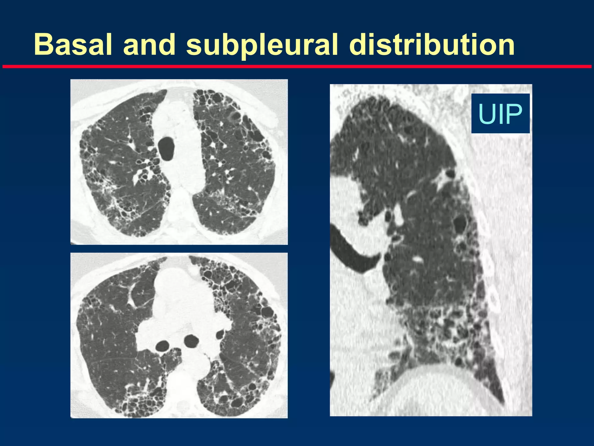Diffuse parenchymal lung diseases (Postgraduate course) | PDF