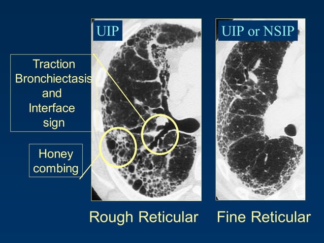 Diffuse parenchymal lung diseases (Postgraduate course) | PDF | Lung ...