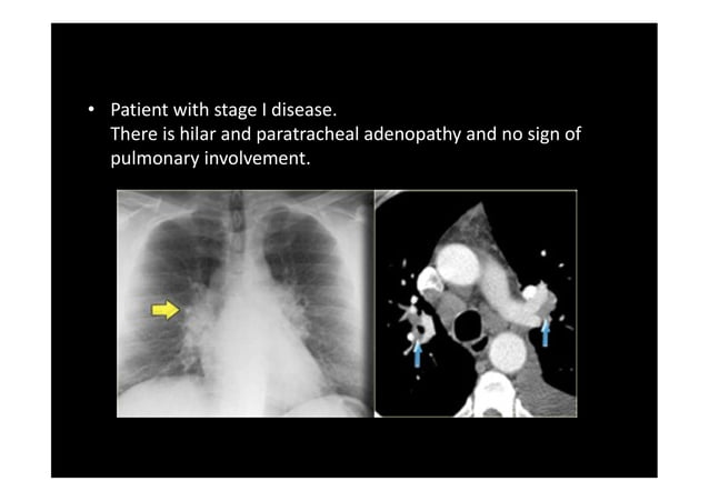 Interstitial lung diseases radiology | PDF