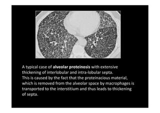 Interstitial lung diseases radiology | PDF