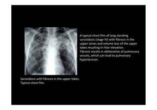 Interstitial Pneumonia X Ray