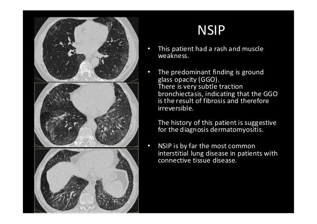 Interstitial lung diseases radiology