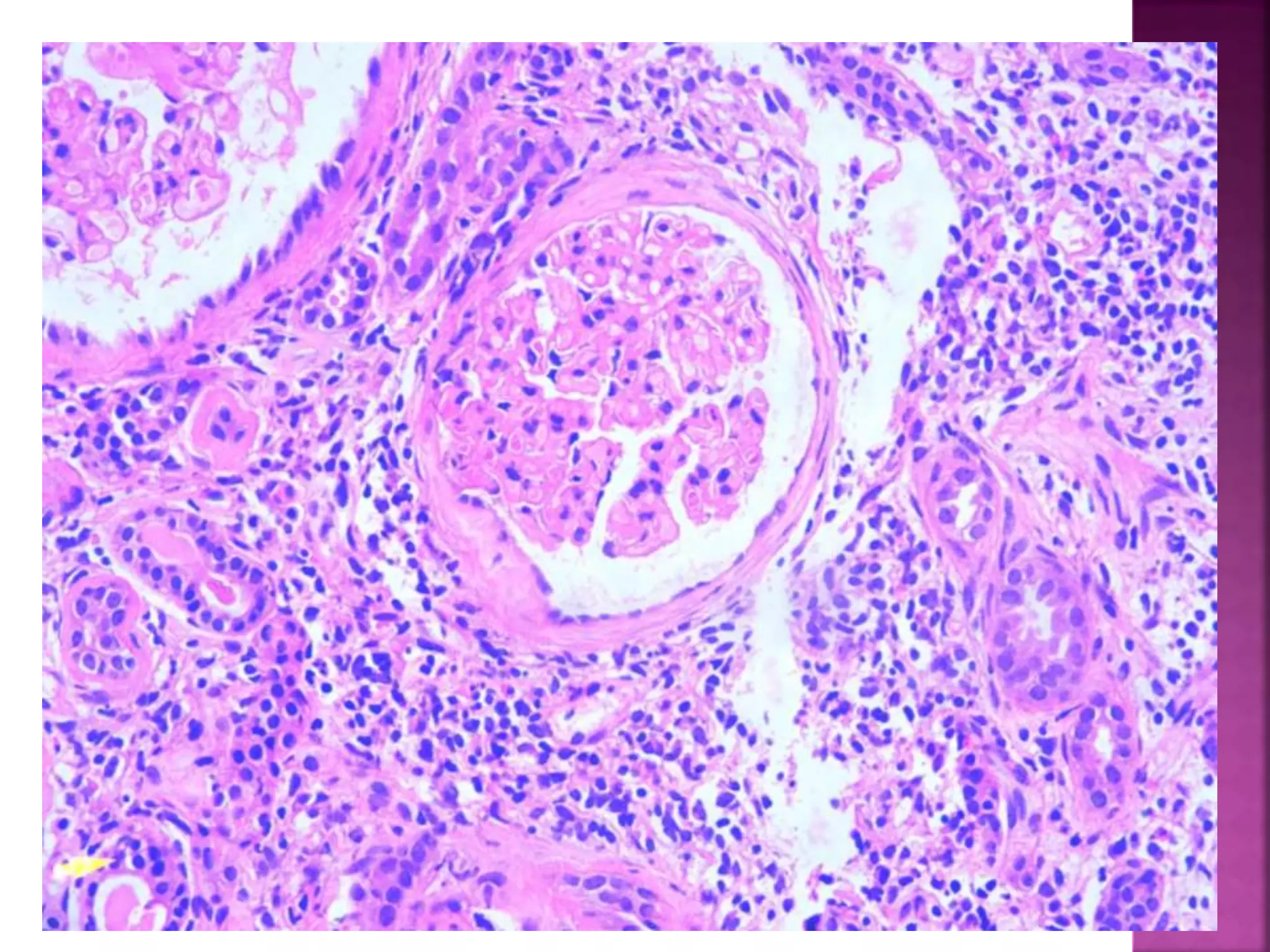 Interstitial nephritis, pyelonephritis and other renal infections | PPTX