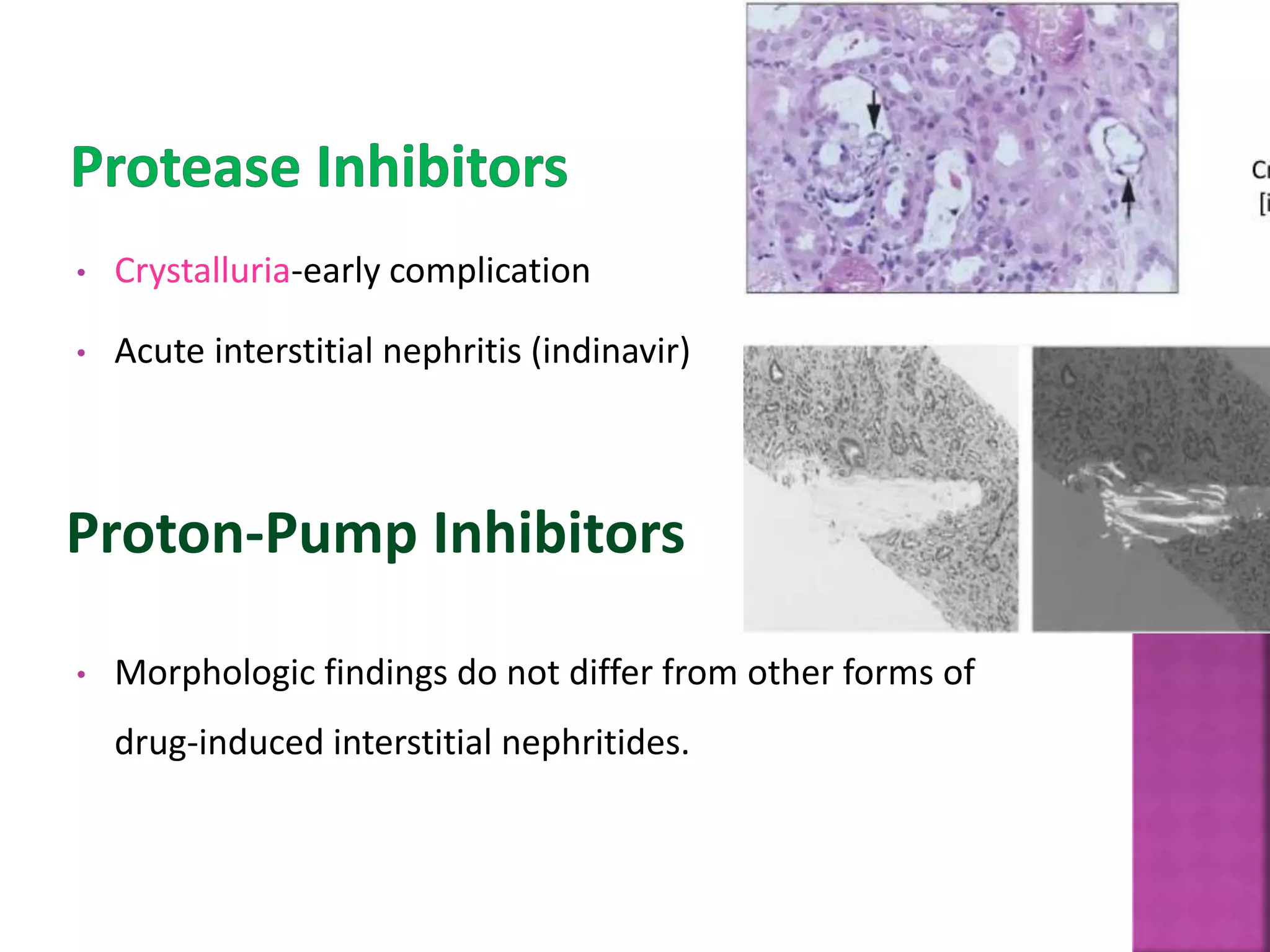 Interstitial nephritis, pyelonephritis and other renal infections | PPTX