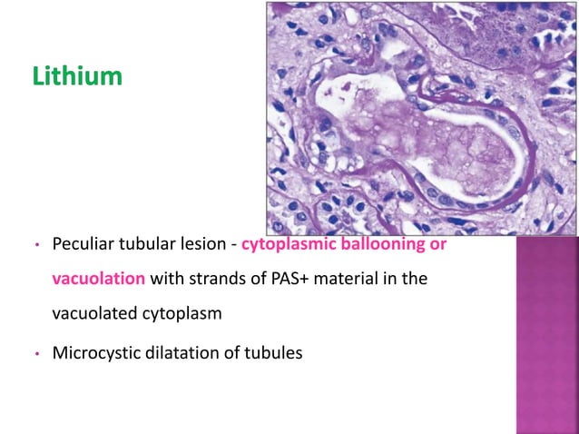 Interstitial nephritis, pyelonephritis and other renal infections | PPT