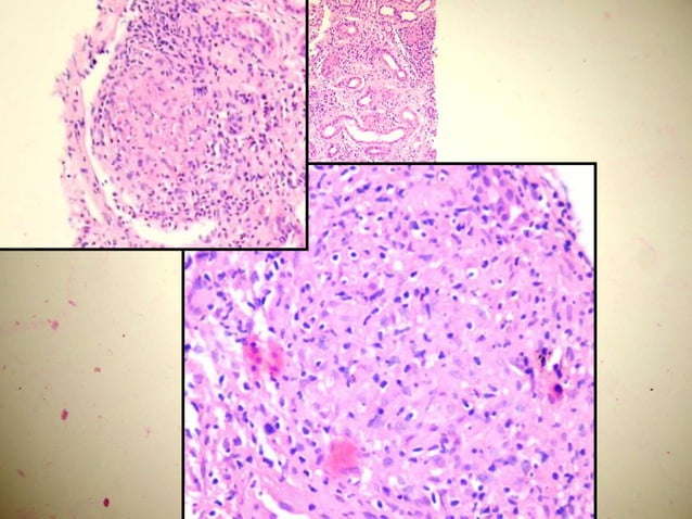Interstitial nephritis, pyelonephritis and other renal infections | PPT