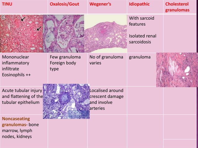 Interstitial nephritis, pyelonephritis and other renal infections | PPT