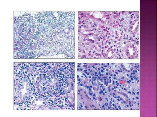 Interstitial nephritis, pyelonephritis and other renal infections | PPT