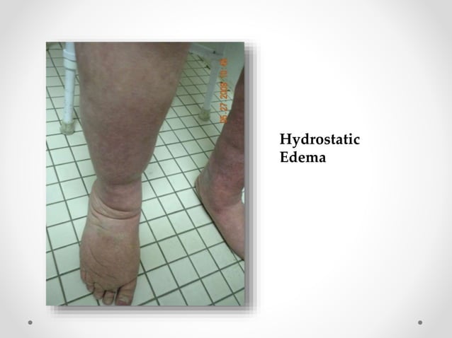 A Simple Method to Quantify Interstitial Soluble Protein Differentiates ...