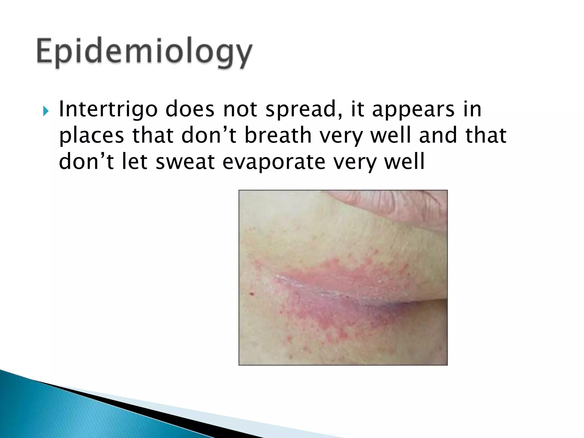Intertrigo presentation Joey B | PPTX