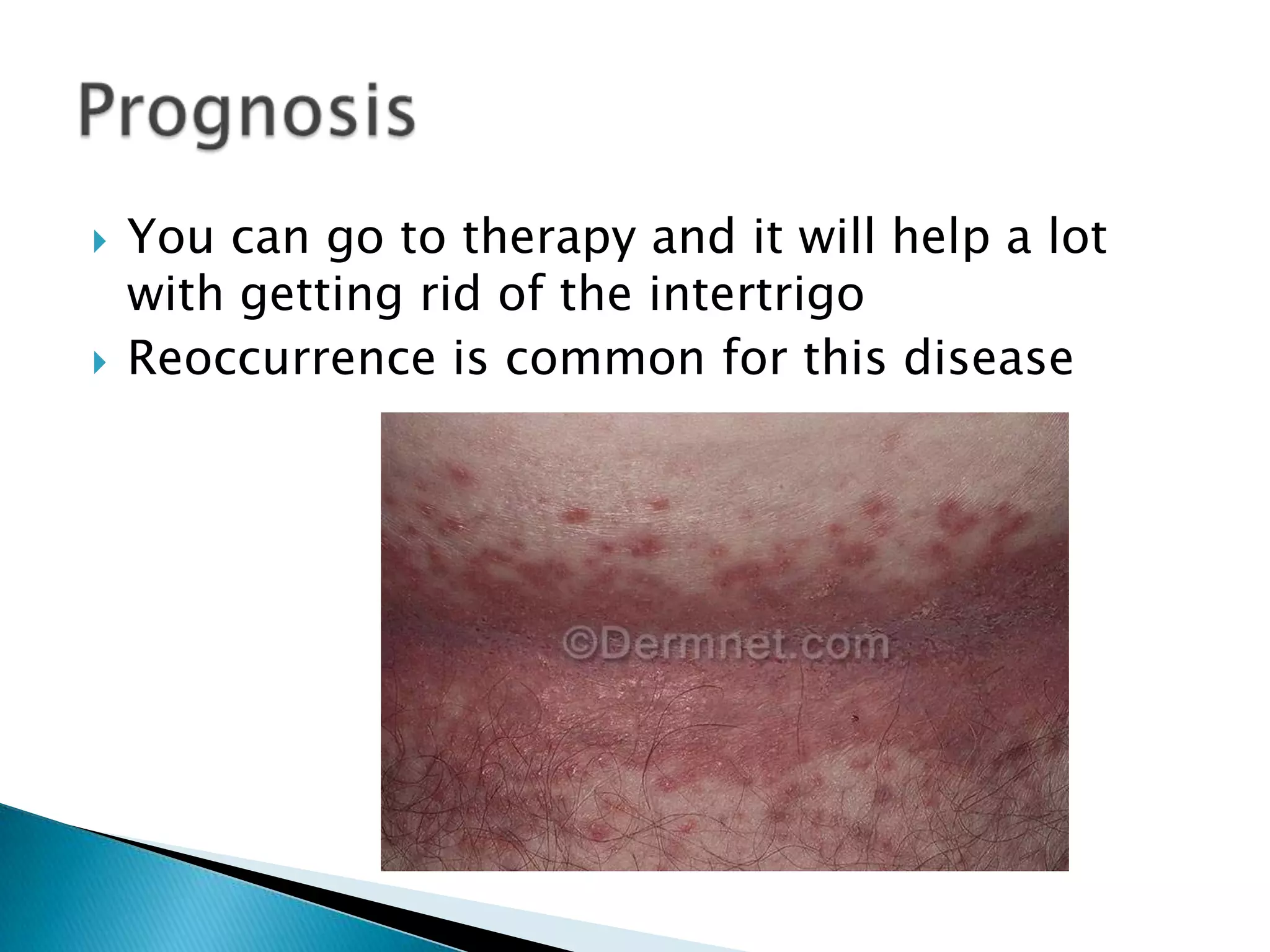 Intertrigo presentation Joey B | PPTX