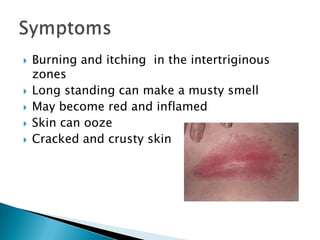 Intertrigo presentation Joey B | PPT