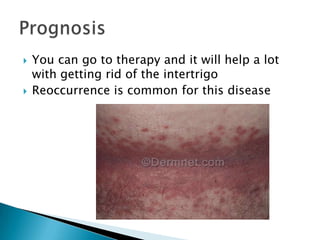 Intertrigo presentation Joey B | PPT