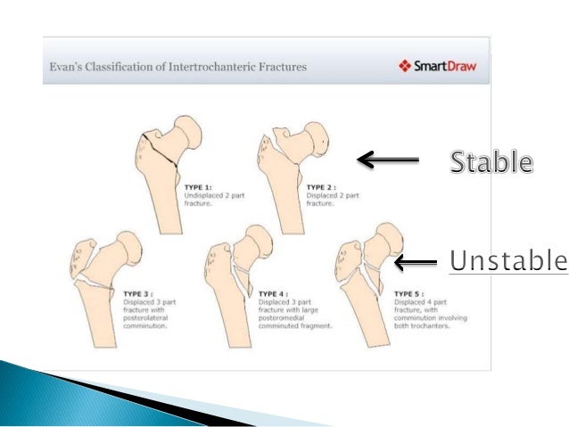 Intertrochanteric fracture (2)