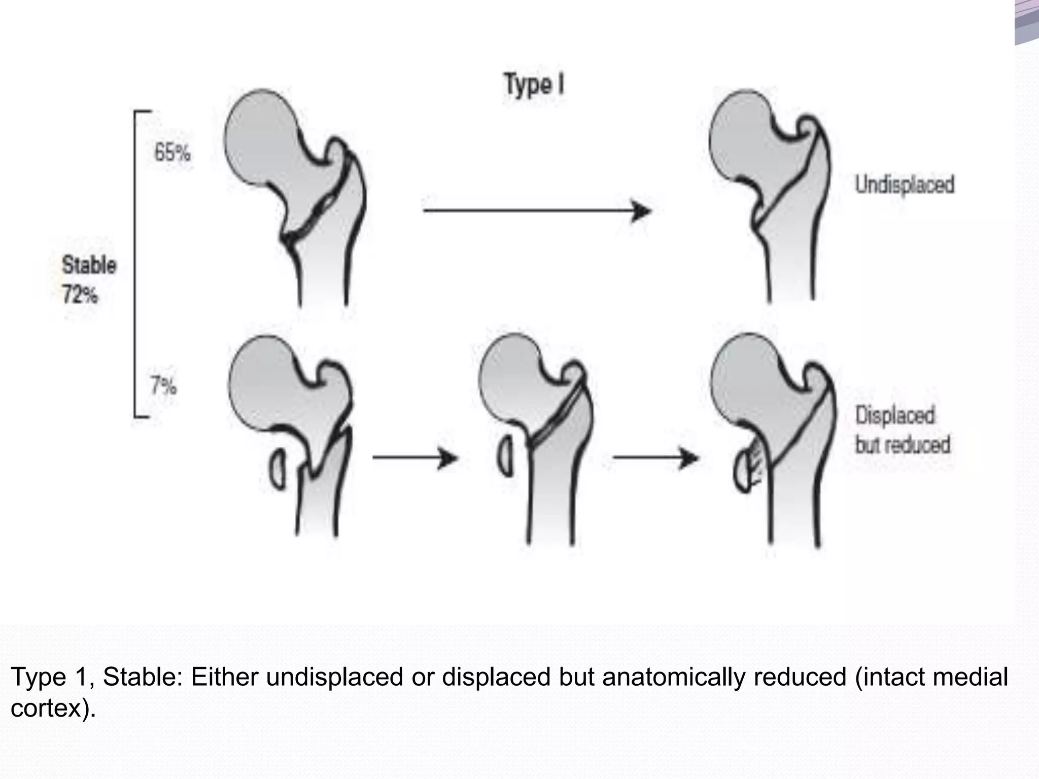 Intertrochanteric fracture femur | PPTX