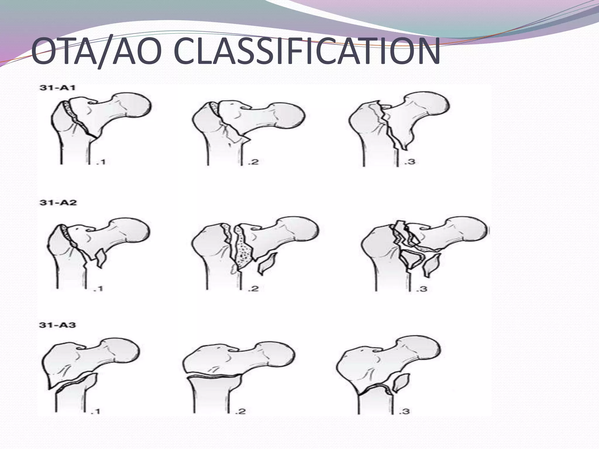 Intertrochanteric fracture femur | PPTX
